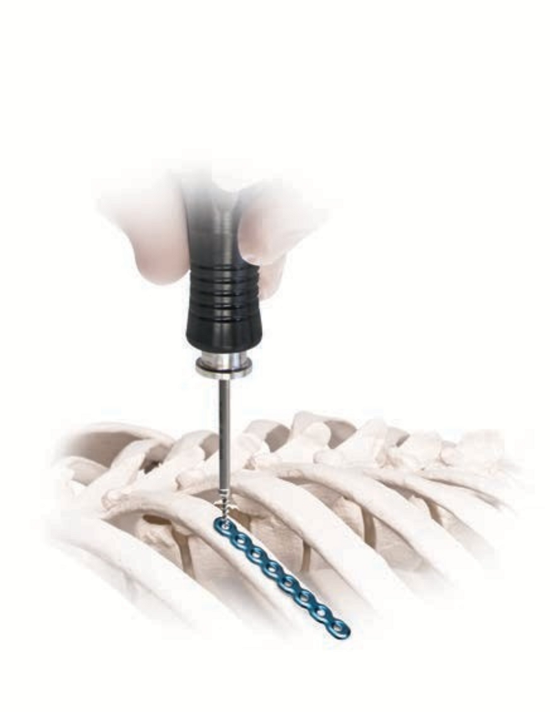 RibFix Blu – Implantartis